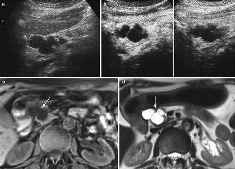 Papillary Mucinous Neoplasm Ipmn Radiology Key