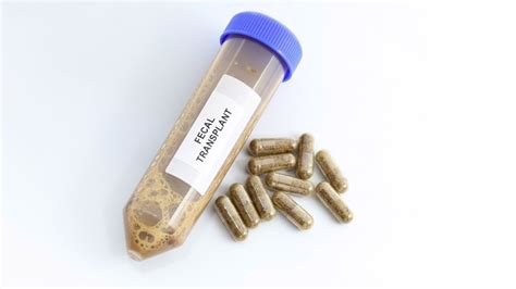 Fecal Transplant A New Approach For Parkinsons Disease