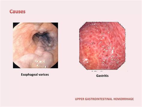 Upper Gastro Intestinal Bleeding Ppt Digestive Disorders Diseases