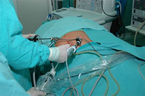 Laparoscopic Radical Nephrectomy Department Of Urology