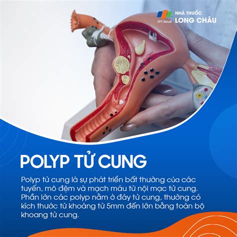 Polyp T Cung L G Nh Ng V N C N Bi T V Polyp T Cung L G Nguy N Nh N Tri U Ch Ng V