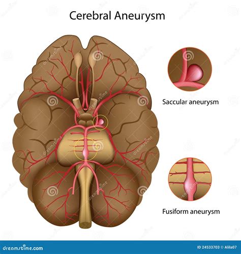 Cerebral Aneurysm Stock Vector Illustration Of Human 24533703