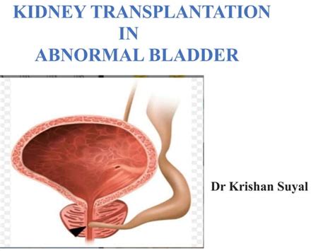 Tx In Abnormal Bladderpptx Ghfdggoibgf Ffghhj Ppt