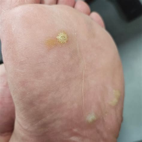 발바닥 물집 지식in