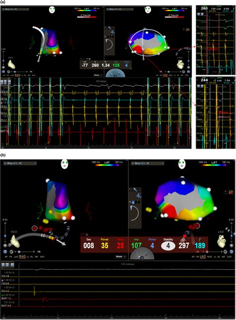 A Atrial Flutter Cycle Length Fcl Is 260 Ms Atrial Flutter Waves Download Scientific