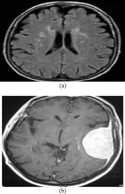 Figure 1 From Brain Hemorrhage Detection Using Heatmaps And Deep Learning Algorithms Semantic