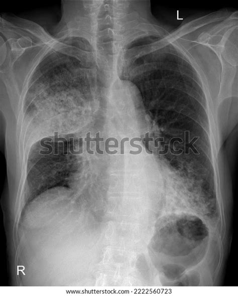 Abnormal Chest X Ray Images