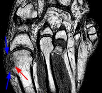 Gout Radsource
