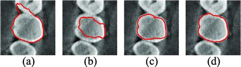 Tooth Segmentation Respectively By A The Level Set Geodesic Flow In