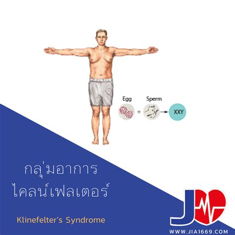 Klinefelters Syndrome Jia1669