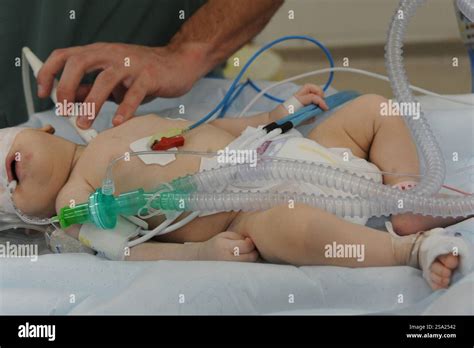 Anestesia Generale Di Un Bambino In Sala Operatoria Anestesia