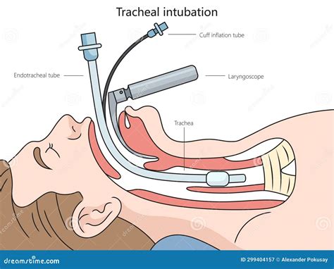 Reason For Tracheal Intubation At Donna Lucero Blog