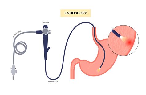 Procedimiento De Gastroscopia Diagnóstico De Enfermedades Estomacales