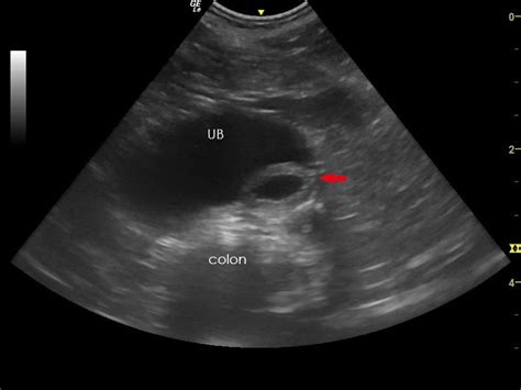 Ultrasound Imaging Urinarybladdertrabeculation3dultrasound