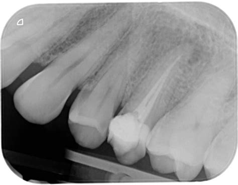 Root Canal Treatment Failed X Ray Should I Go For Re Treatment Or