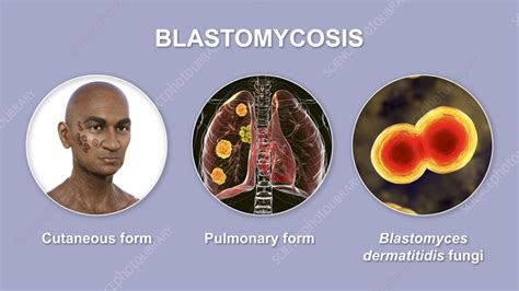 Clinical Presentations Of Blastomycosis 3d Illustration Stock Image F0424946 Science