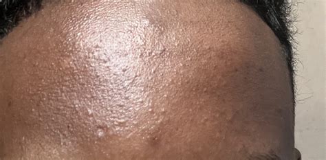 Best Recommended Treatment For Acne Scarhyperpigmentation Acne Scars