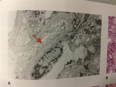 USMLE Renal And Genitourinary Flashcards Quizlet