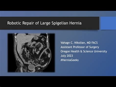Ventral Hernia 23 Spigelian Hernia Repair Behind The Knife The