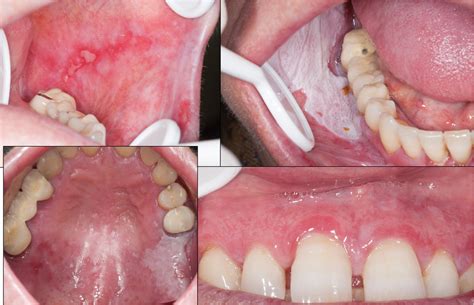 Oral Lichen Planus And Related Lesions What Should We Accept Based On The Available Evidence