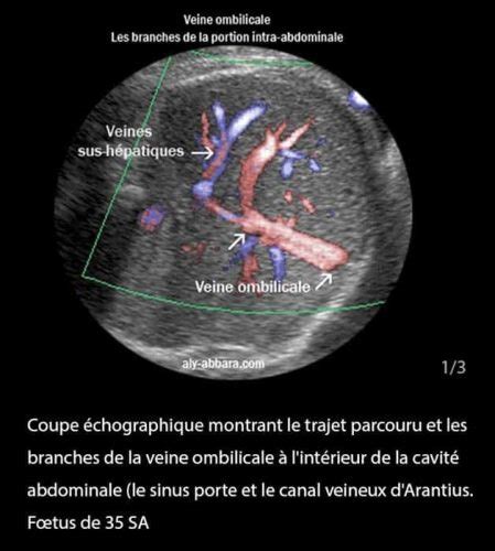Doppler Du Canal Darantius Ou Ductus Venosus Dr Kara Zaitri Ma