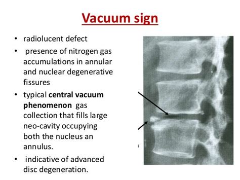 Degenerative Disc Disease With Vacuum Phenomenon Captions Profile