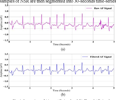Figure 1 From Detection Of Atrial Fibrillation Based On Synchronized
