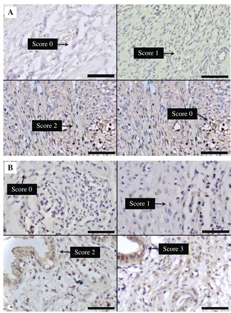The Staining Intensity And Tnf A Expression Of Endometriomas
