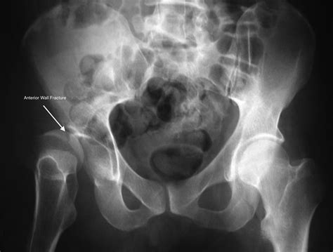 Acetabulum Fracture