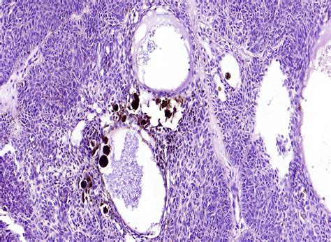 Pathology Outlines Basal Cell Carcinoma