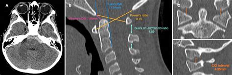 A Axial Ct Scan Showing The Prepontine And Premedullary Subarachnoid Download Scientific