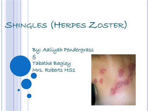 Ppt Shingles Herpes Zoster Powerpoint Presentation Free Download