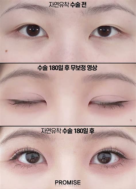 자연유착으로 쌍꺼풀 라인 선명하게 만들기 💡 프라미스성형외과 Youtube