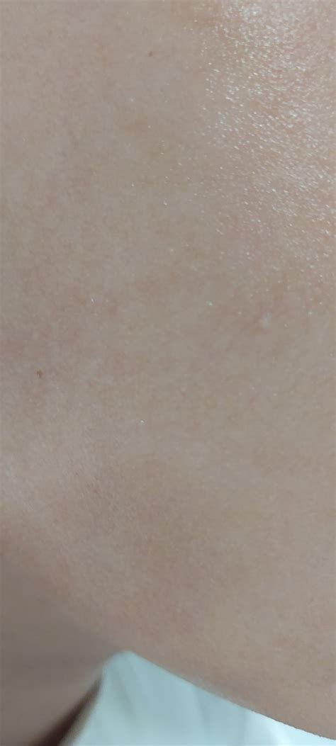 중1 여드름 여드름 없애는법 지식in