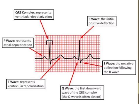 Heart Block Pptx