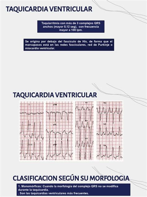 Taquicardia Ventricular Pdf