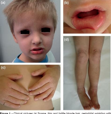Ectodermal Dysplasia Syndrome Related Healthjournals Ectodermal