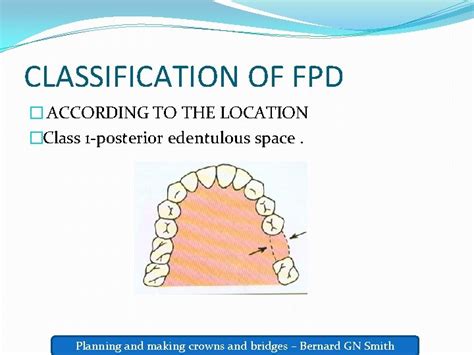 General Considerations Components And Classification Of Fpd Christeena
