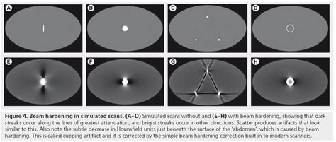 Ct Artifacts Causes And Reduction Techniques