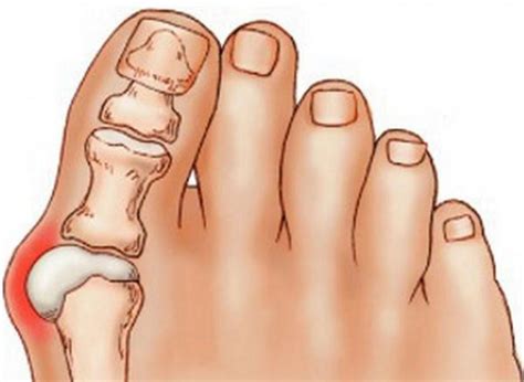 ШИШКУ НА НОГЕ УБИРАЕМ КОПЕЕЧНЫМИ СПОСОБОМ