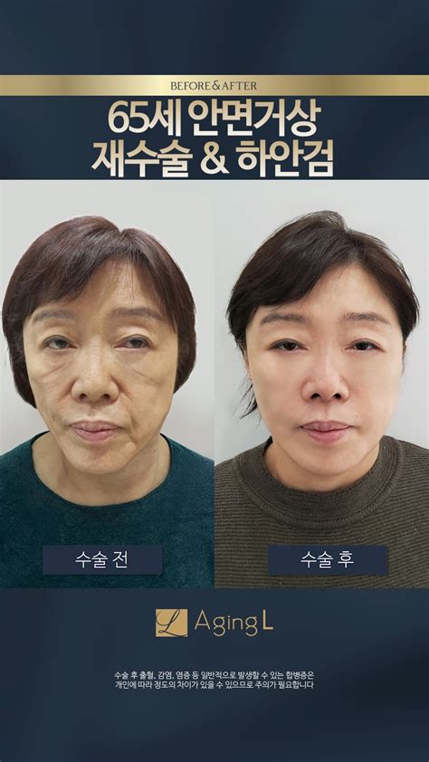 에이징엘 안티에이징 성형외과 📢 정직함과 실력의 자신감 에이징엘성형외과 Cctv 참관 시스템 의사와 환자 사이에서 가장