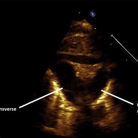 Suprasternal Frontal View Demonstrates A Left Transverse And Right Download Scientific Diagram