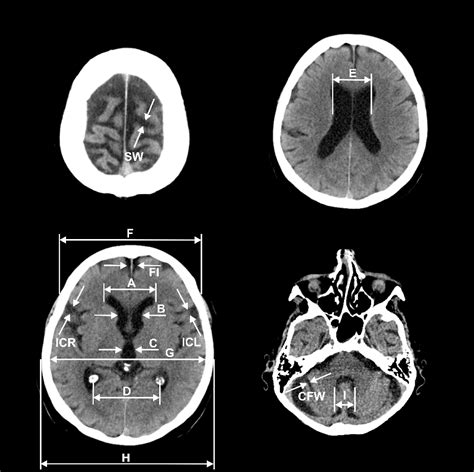 Figure 1 From Computed Tomography Assessment Of Brain Atrophy In Centenarians Semantic Scholar