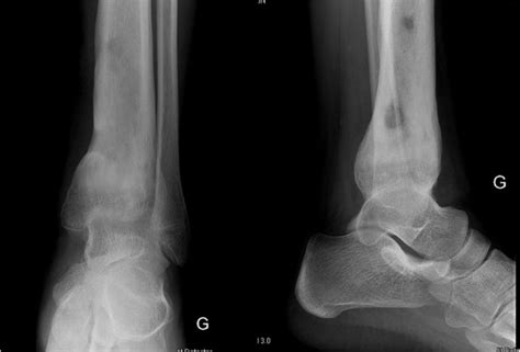 Late Control X Rays Of The Affected Tibia Three And A Half Months After