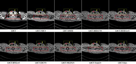 Difference Images Between Ldct And The Denoised Images Download Scientific Diagram