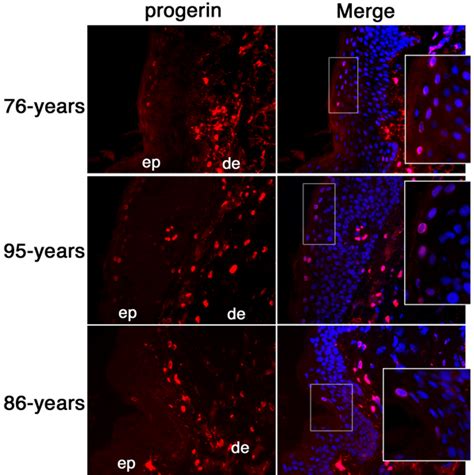 Progeria Cell Mutation