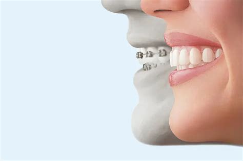 Aligners Vs Braces A Detailed Comparison