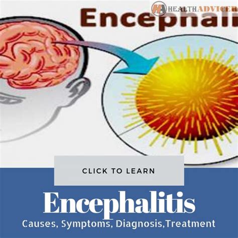 Encephalitis Treatment