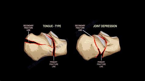 Ankle Avulsion Fracture Symptoms Treatment