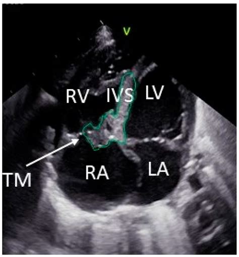Cardiac Rhabdomyoma